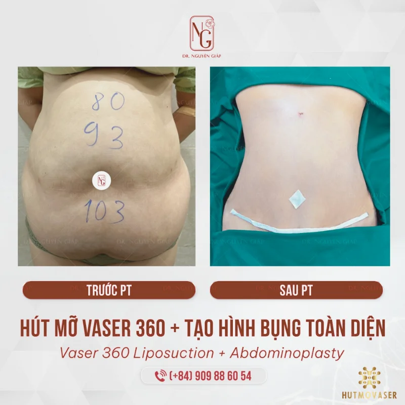 What is Lipo Ultrasound? Method to create a slim waist - hutmovaser.com