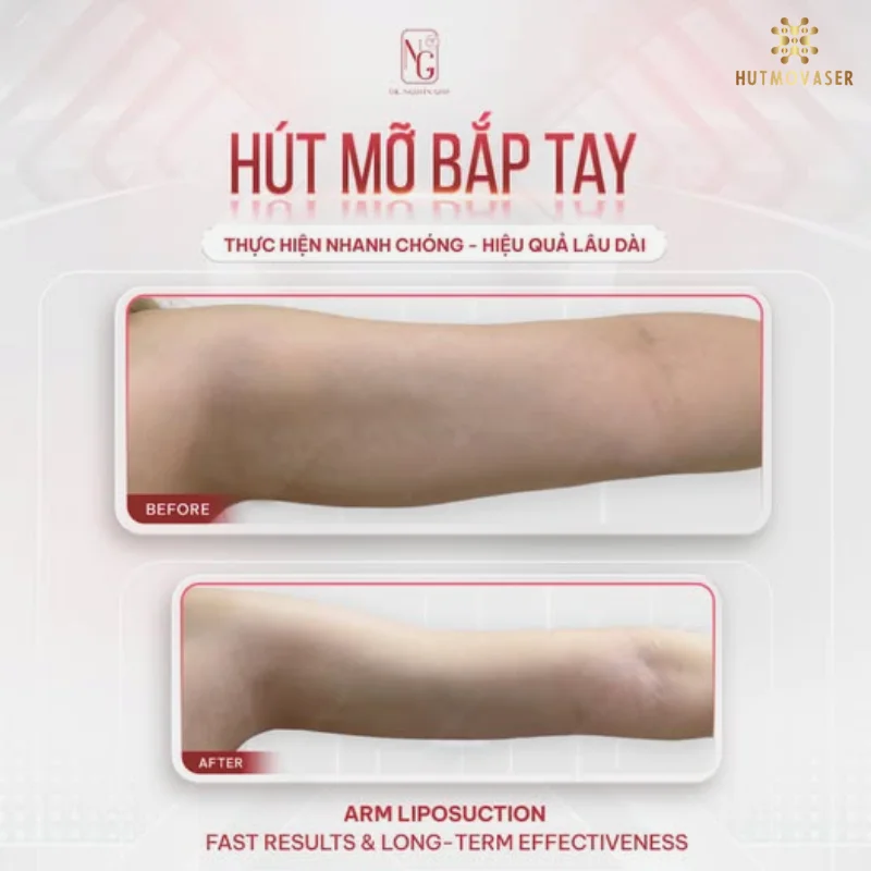 What should you avoid eating after arm liposuction to recover quickly ...